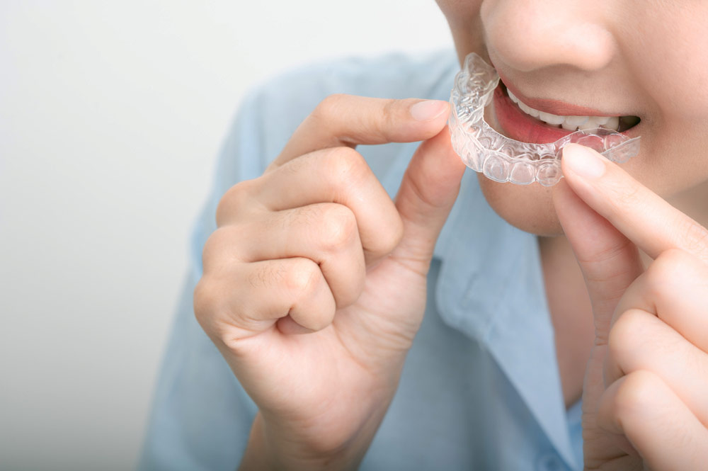 How Do Clear Aligners Work - Jonny Fisher DDS