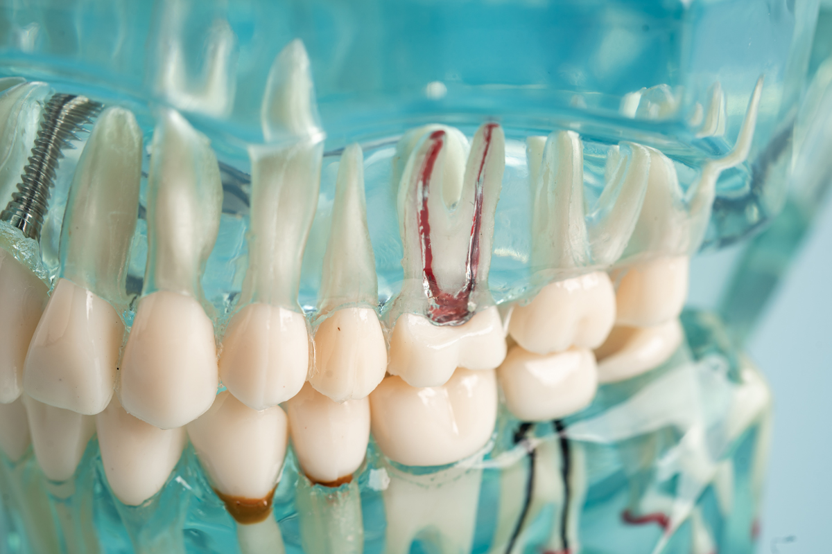 How Long Does A Root Canal Take? - Jonny Fisher DDS